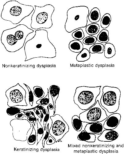 Fig. 15. Metaplastic dysplastic cells and a superficial squamous cell ...