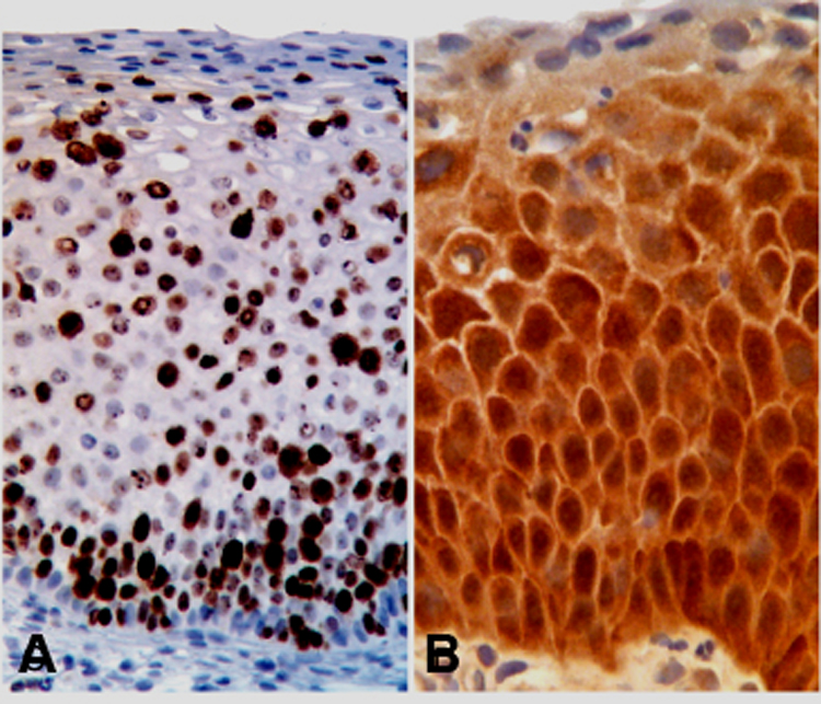 Pathology of Cervical Carcinoma | GLOWM