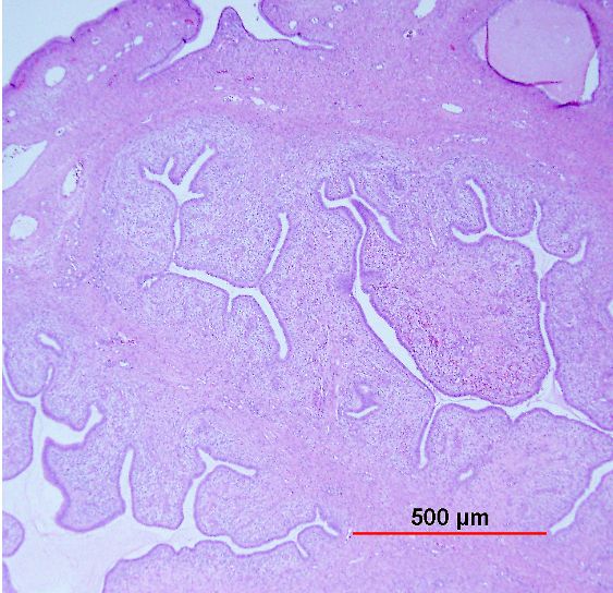 Pathology of Cervical Carcinoma | GLOWM