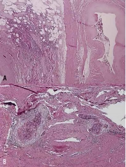 Pathology of Cervical Carcinoma | GLOWM